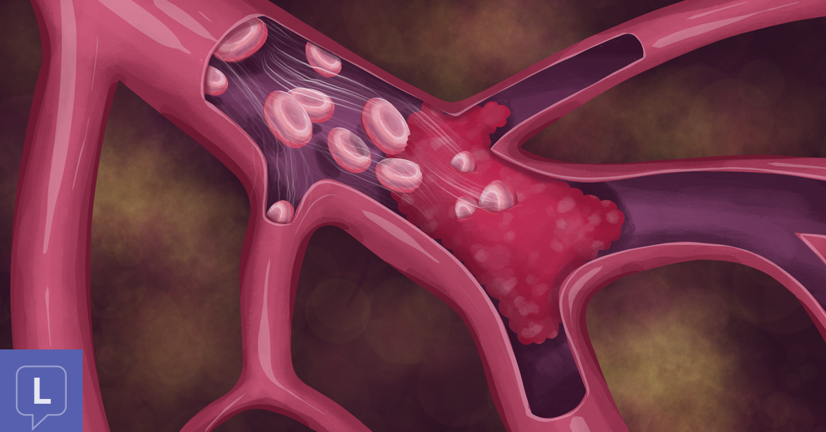 Tips to Prevent and Manage Blood Clots with Lupus