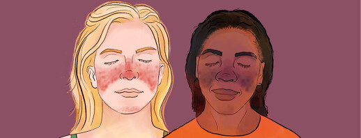 What are Complications and Comorbid Conditions of Lupus?